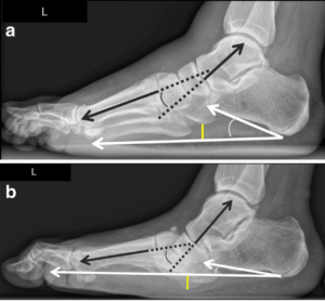 Charcot Foot: Symptoms, Causes, and Treatments | Diabetes Care