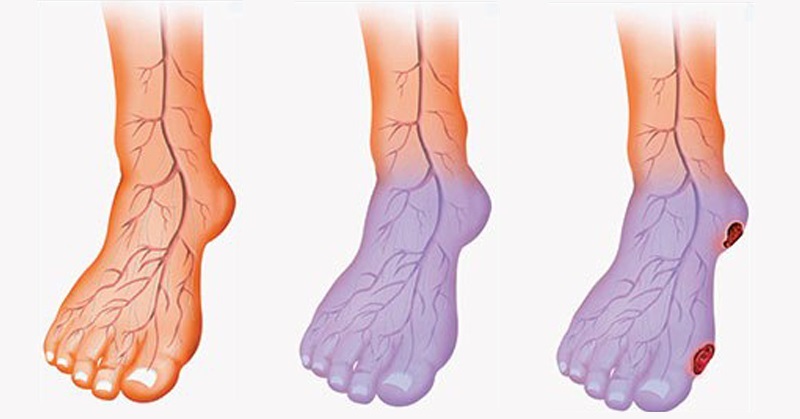 Diabetic Ulcers: Causes, Symptoms, Types, Treatments