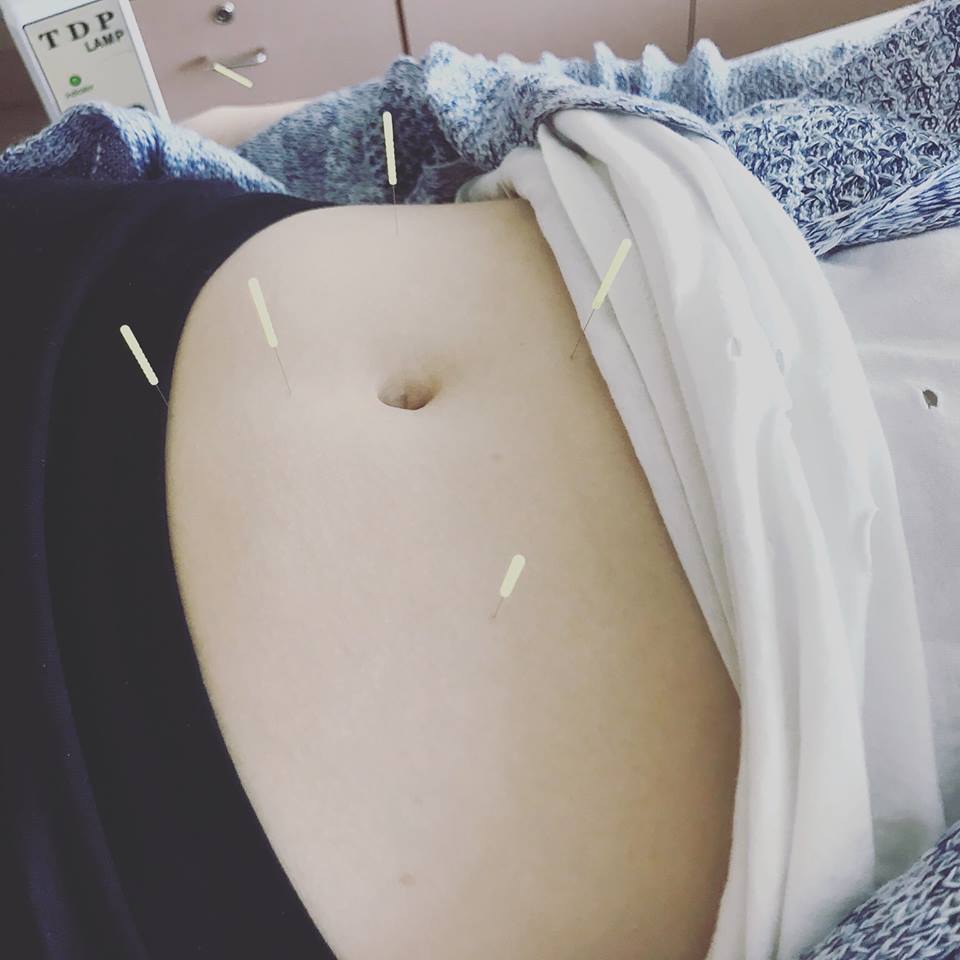 Acupuncture For Weight Loss: Meaning, Benefits, Alternatives