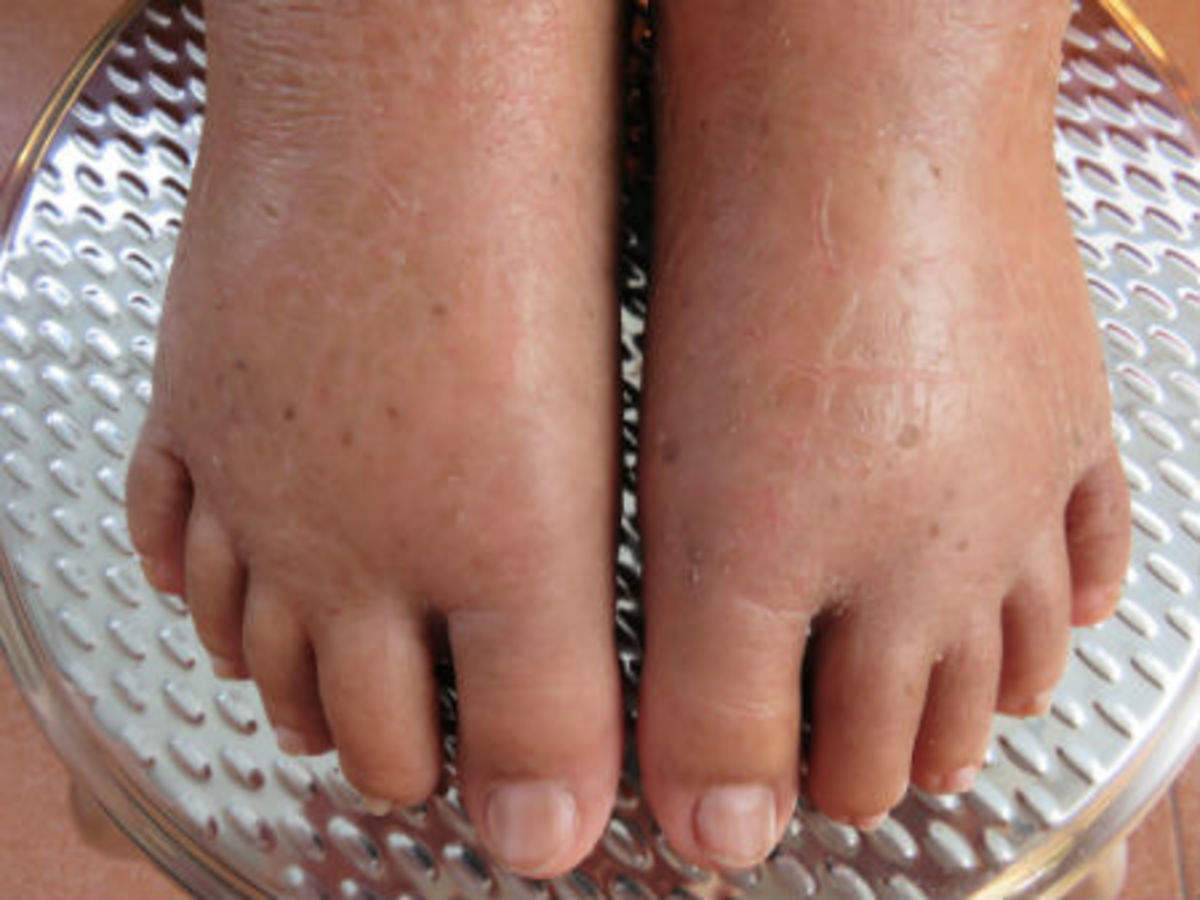 Causes Of Fluid Retention: Definition, Causes And Solutions