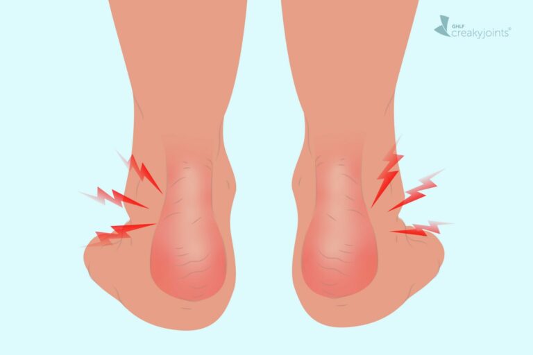 Bump On Back Of Heel: Top 6 Causes, Signs And Tips To Help
