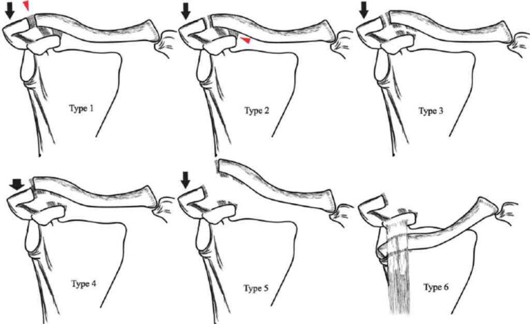AC Joint Pain : Types, Treatment And Exercises