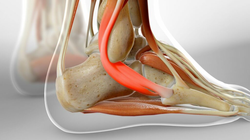 Peroneal Tendonitis: Meaning, Causes, Treatment And Tips