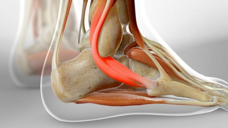 Peroneal Tendonitis: Meaning, Causes, Treatment And Tips
