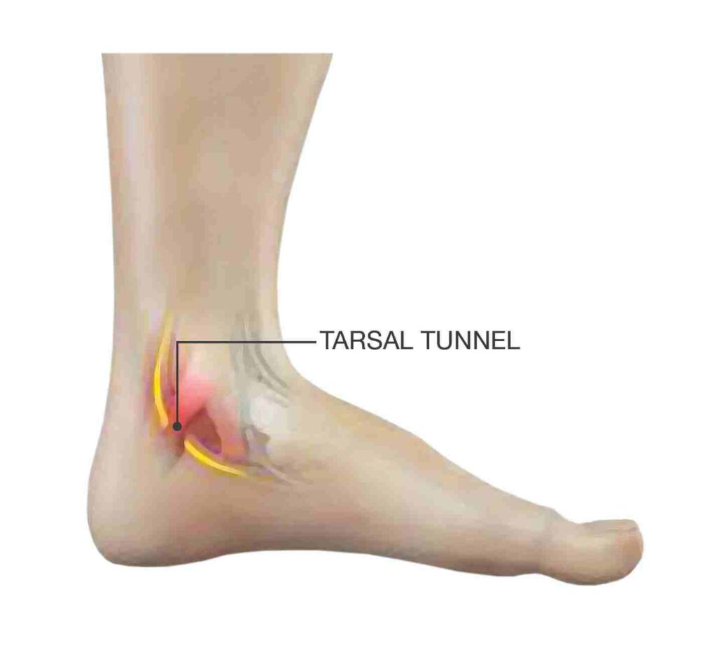 Tarsal Tunnel Syndrome: Meaning, Physiotherapy Exercises