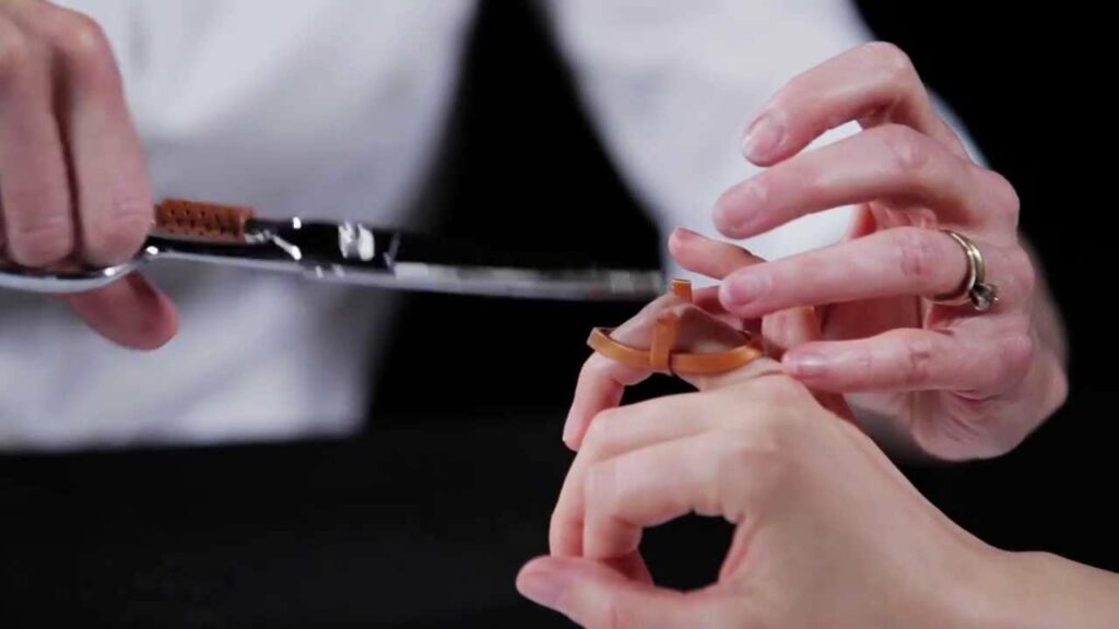 Swan Neck Deformity of the Finger: Detailed Guide