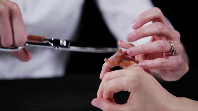 Swan Neck Deformity of the Finger: Detailed Guide