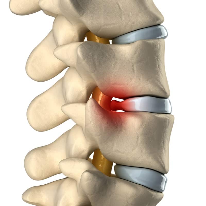 Bulging Discs | Physical Therapy For Bulging Discs