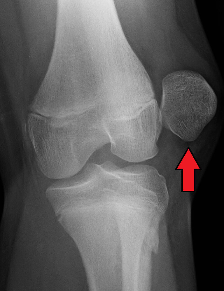 Patellar Instability: What You Need To Know