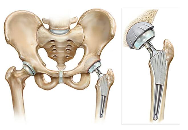 Physical Therapy For Total Hip Replacement