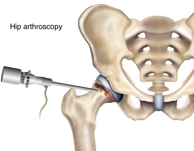 Hip Arthroscopy: 5 Steps To Prepare And What To Expect