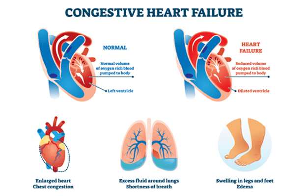 Physical Therapy for Congestive Heart Failure