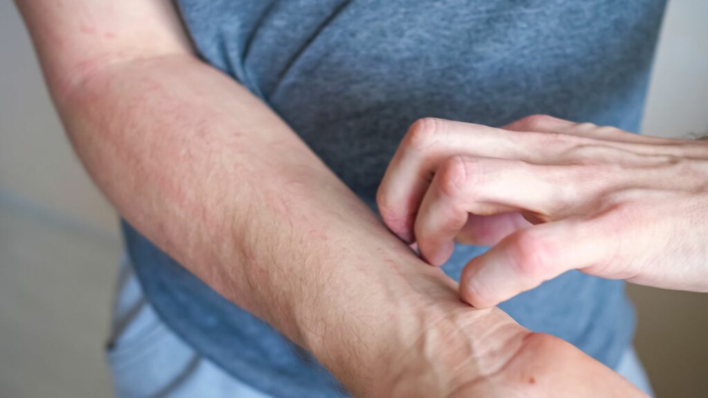 Dermatillomania OCD - Signs, Causes, Diagnosis, And Treatments